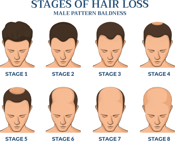 Hair Loss In Men Male Hair Loss Cranial Prosthesis Center